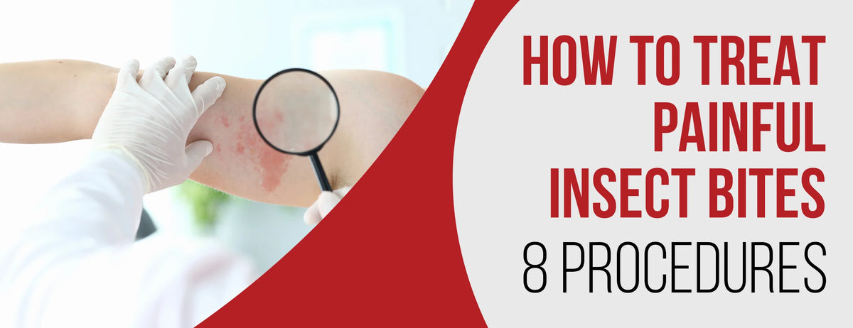 How To Treat Painful Insect Bites: 8 Procedures – Glamour Shop UK